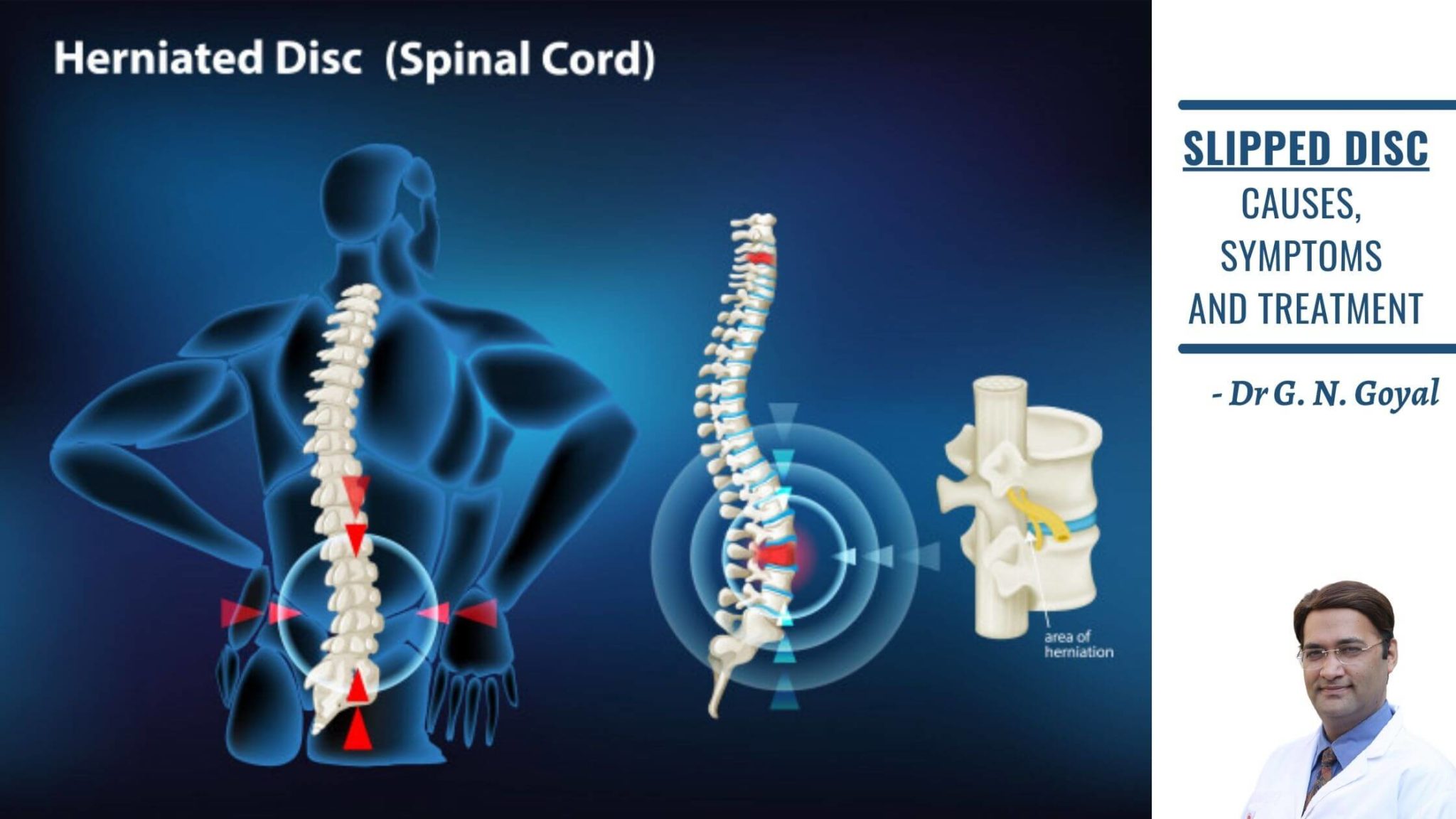 SLIPPED DISC CAUSES SYMPTOM TREATMENT Dr G N GOYAL SLIPPED DISC CAUSES SYMPTOM TREATMENT Dr G N GOYAL